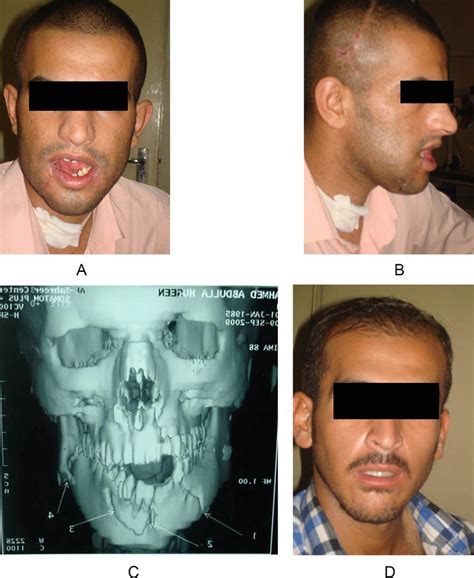 Skull Fracture Deformity