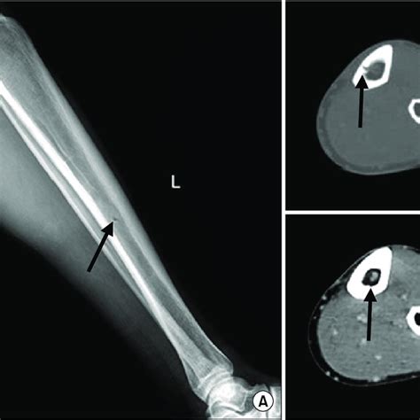 A Simple Radiography Revealed A Cortical Bone Defect In The Tibia Download Scientific Diagram