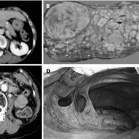 Repeat Pure Laparoscopic Hepatectomy For Patients With Liver Cirrhosis Download Scientific