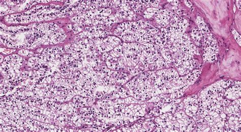 Tfe3 Rearranged Renal Cell Carcinoma Ottawa Atlas Of Pathology