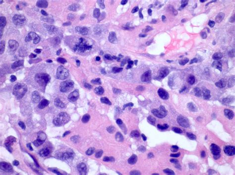 Pathology Outlines Chromophobe
