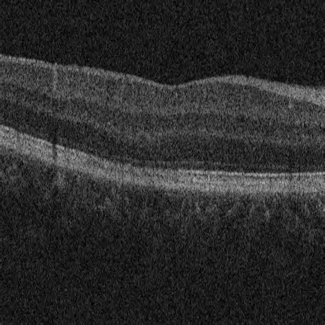 pdf automated segmentation of macular edema in oct using deep neural networks