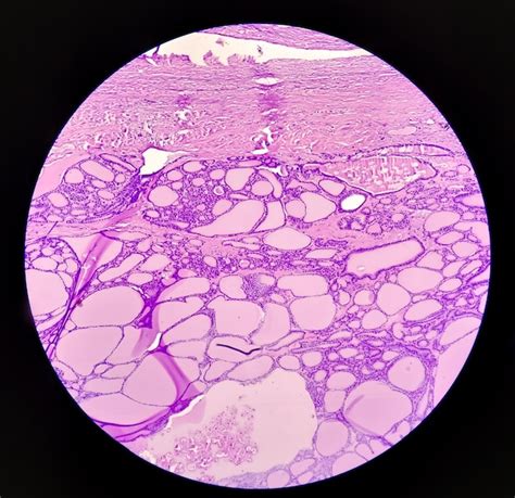 Premium Photo Synovial Sarcoma Histology Image Analyzed By Microscope