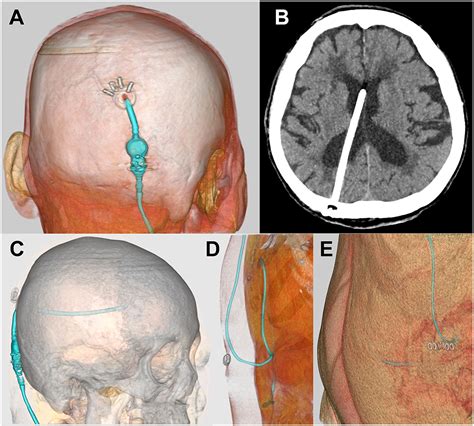 Codman Programmable Shunt Brain