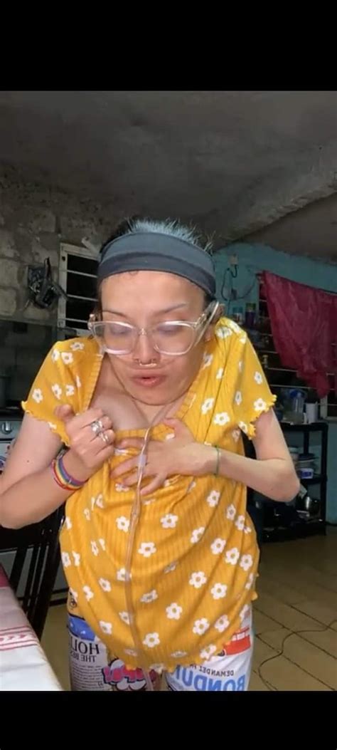 Yaniz Lucra Con Su Enfermedad