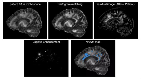 Multimodal Mri Statistical Segmentation Of Normal Appearing White
