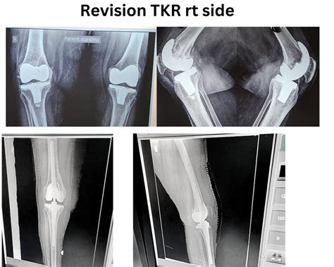 Dr Naresh Agarwal On Linkedin Recently Did A Revision Tkr In A Aseptic Loosening 14 Years Post