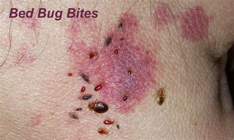 Bed Bug Bites On Genital Area