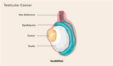 Tumors Of The Testicles Types Causes Symptoms Treatment Healthy
