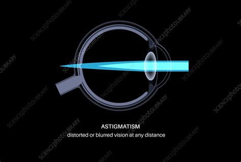 Astigmatism Eye Condition Illustration Stock Image F0438392