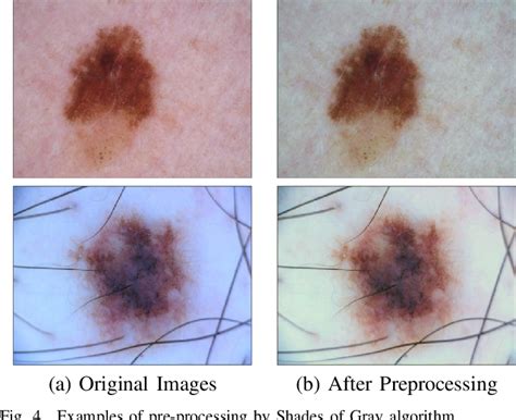 Automatic Lesion Boundary Segmentation In Dermoscopic Images With