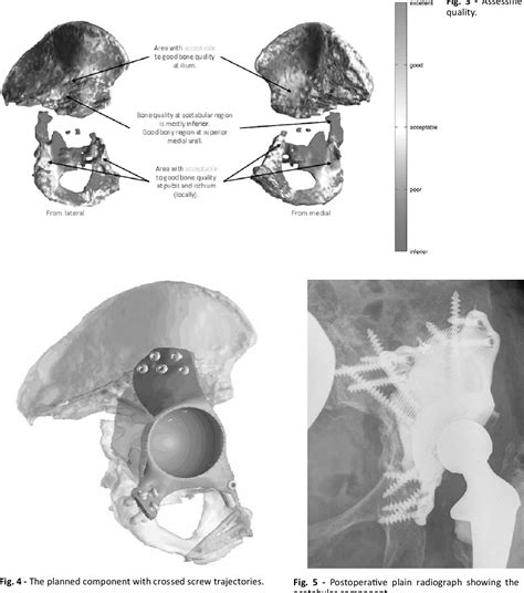 Figure 4 From Preliminary Results Of A 3d Printed Acetabular Component In The Management Of