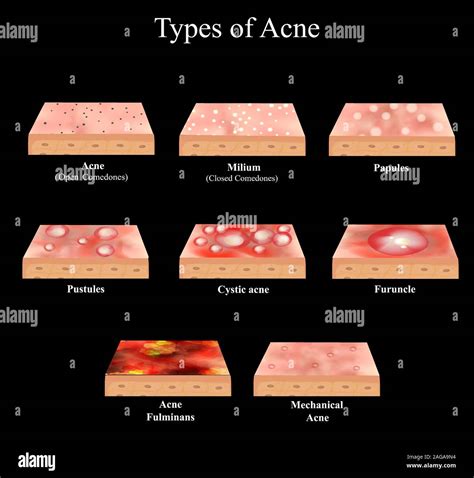 Types Of Papules Les Différentes Papules Zgjnk