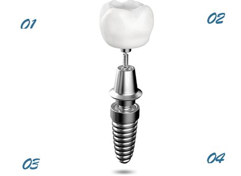 Front Tooth Implant Idhospital