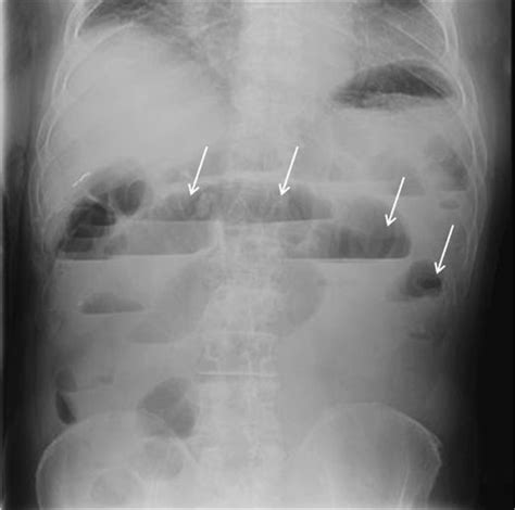 Small Bowel Obstruction Anesthesia Key
