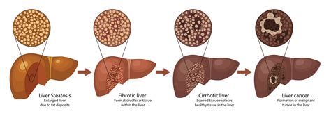 Nonalcoholic Steatohepatitis Nafld Nonalcoholic Fatty Liver Disease