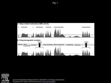 Sleep Less And Bite More Sleep Disorders Associated With Occlusal Loads During Sleep Takafumi