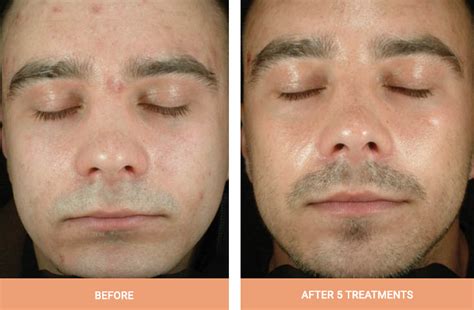 Photodynamic Therapy Pdt Alive Skin And Medical Centre