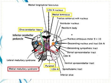 Brainstem Stroke Syndromes Pptx