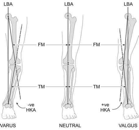 Osteotomy Prof Verdonk