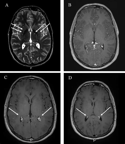 Fungal Meningitis Mri