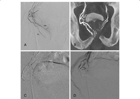 a selective right prostatic artery dsa in oblique view showing the