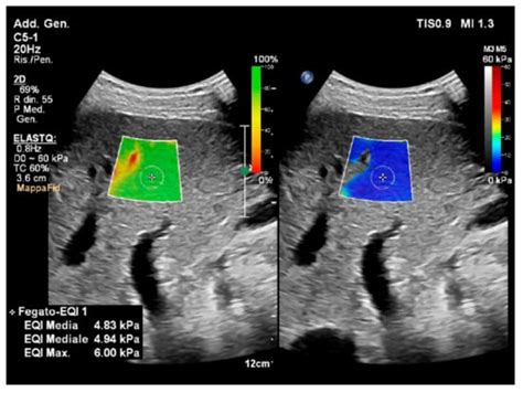 Biomedinformatics Free Full Text Ultrasound Elastography Basic