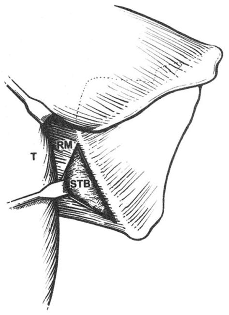 Scapulothoracic Bursectomy For Snapping Scapula Syndrome Journal Of Shoulder And Elbow Surgery