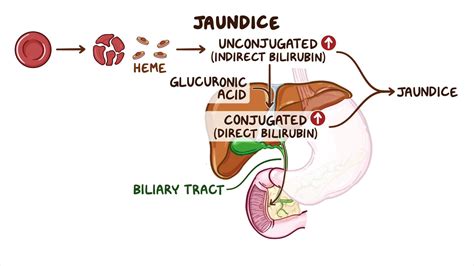 Approach To Jaundice Unconjugated Hyperbilirubinemia Clinical