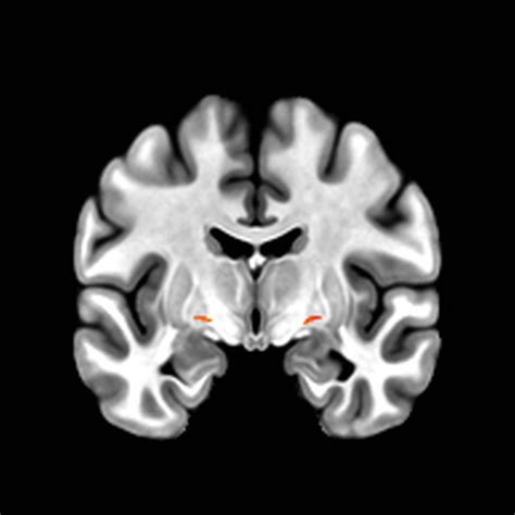 Nucleus Basalis Of Meynert Afni Message Board Afni Discuss Message