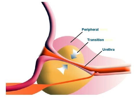 Dysfunctional Voiding Patterns Urinary Incontinence Urinary Retention Bph