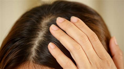 Severe Dandruff Scalp