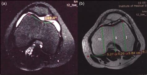 Trochlear Dysplasia A Axial T2w Image Of A Patient With High Sulcus