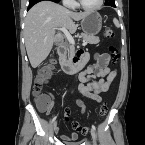 Duodenal Diverticulum Pacs