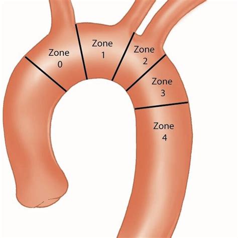Proximal Landing Zones For Aortic Arch And Upper Descending Thoracic