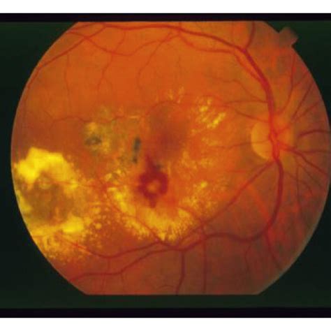 Original Retinal Images And Their Corresponding Segmentation Results By