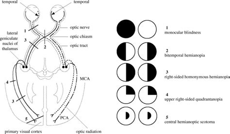 A Brain Stroke Can Cause Hemianopia Partial Or Complete Blindness An Eye Care Blog