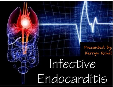 Infective Endocarditis Pdf