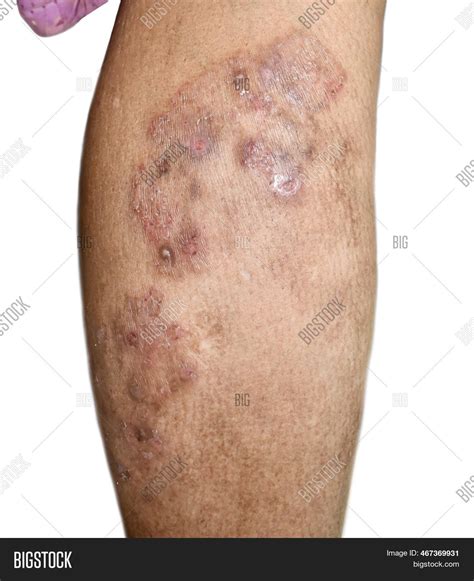 Fungal Infection Image And Photo Free Trial Bigstock