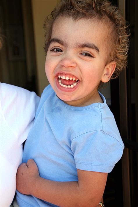 Costello Syndrome Positive Exposure