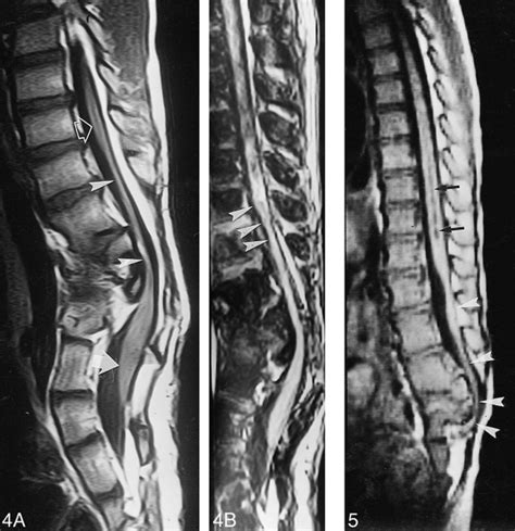 Spina Bifida Risonanza Magnetica Spina Bifida Nata In Buone
