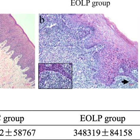 Large Amount Of Lymphocyte Infiltrated In The Lamina Propria Of Olp A Download Scientific
