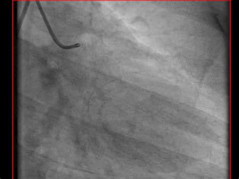 Pierfrancesco Agostoni On Linkedin Neovasc Reducer