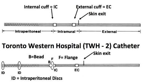 Tenckhoff Catheter Oreopoulos Zellerman Or Twh Catheter Is Shown At The