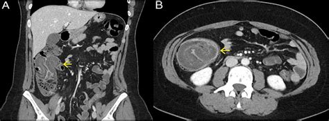 Intussusception After Routine Colonoscopy A Rare Complicati Acg Case Reports Journal