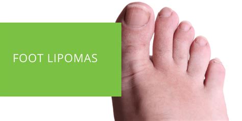 Lipoma On Sole Of Foot Factory Sale