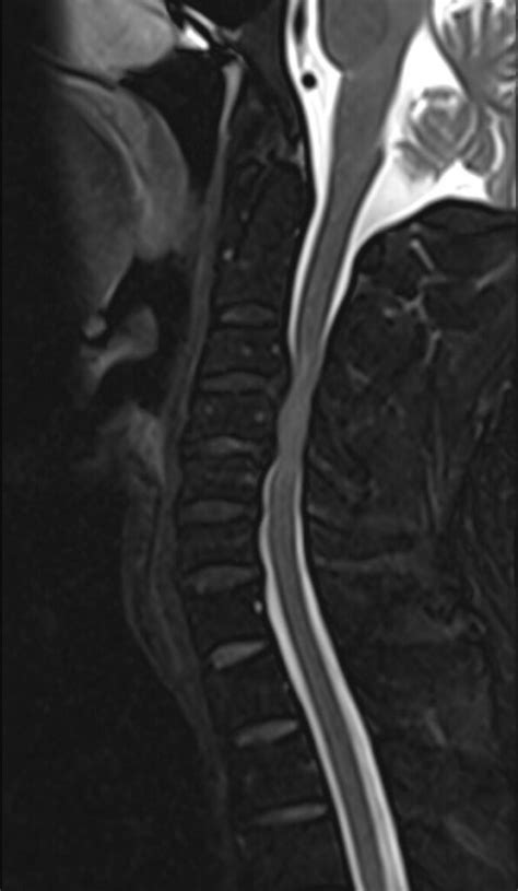 A Case Report Of A Man With Burning Arm And Leg Weakness Jetem