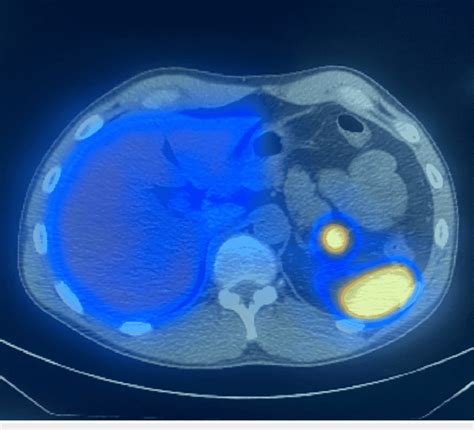 Spect Ct Fusion Imaging Demonstrating Splenic And Ectopic Radiotracer Download Scientific
