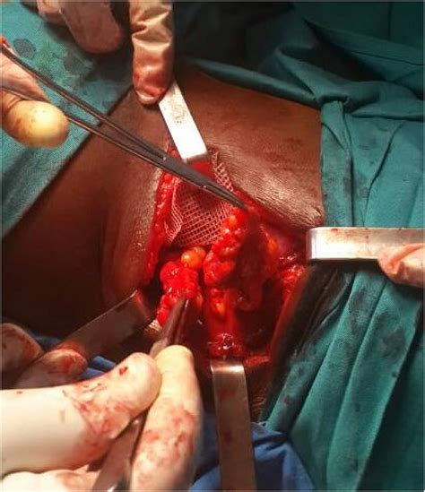 Peritoneal Fat In The Hernia Download Scientific Diagram