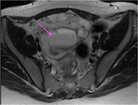 Diagnosis And Management Of High Risk Gastrointestinal Stromal Tumor In
